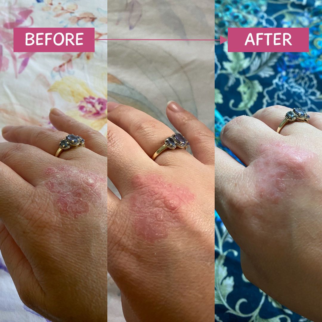 Breakthrough Pink Eczema Cream | Quick & Gentle Relief from Eczema ...